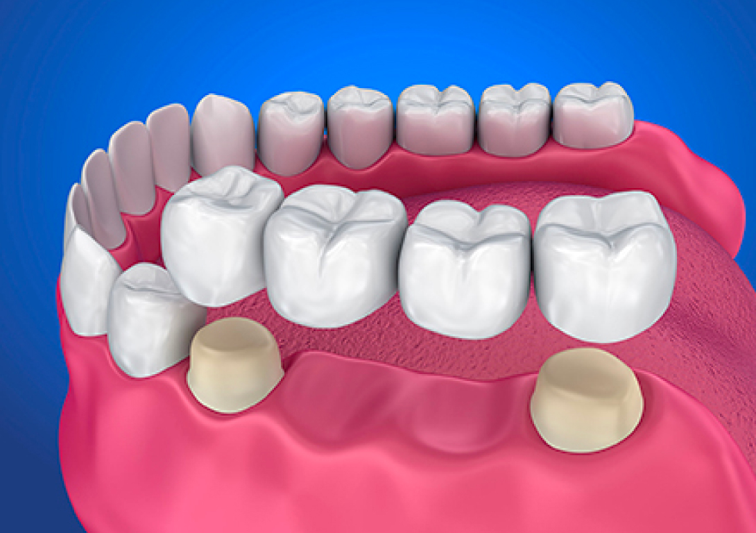 Próteses Dentárias - Odonto Alberti